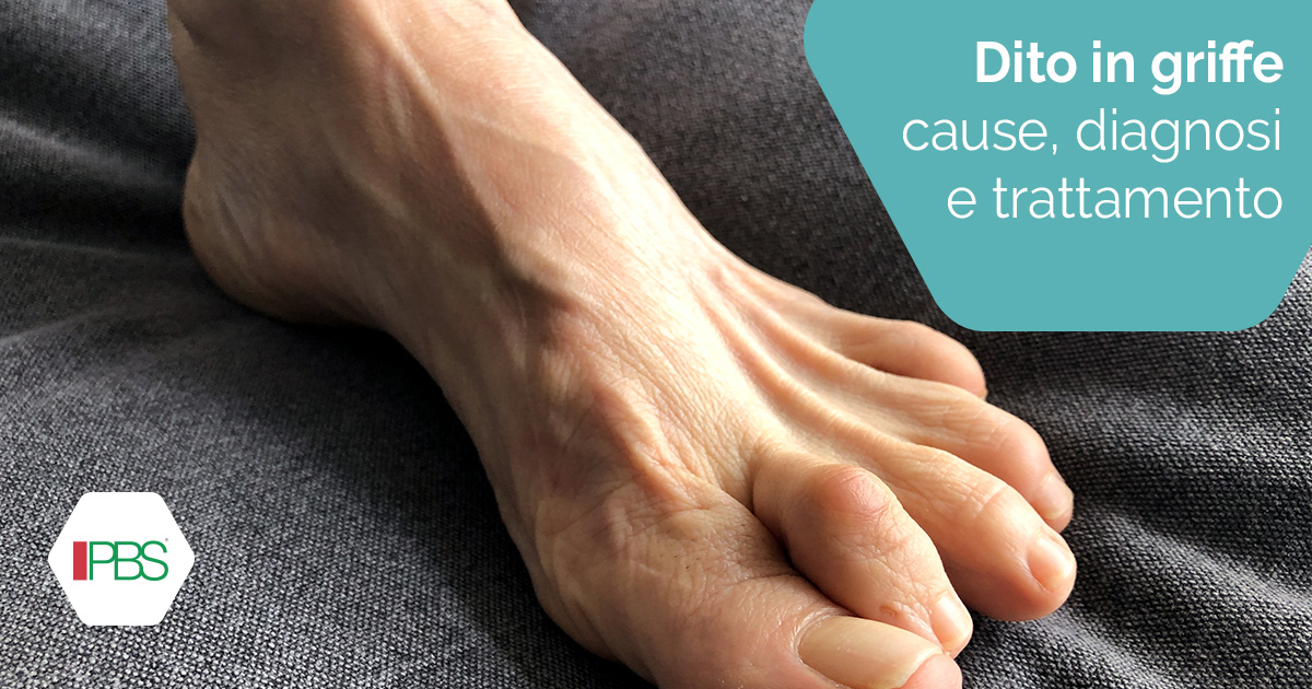 Dito del piede in griffe - Diagnosi e Cura - PBS