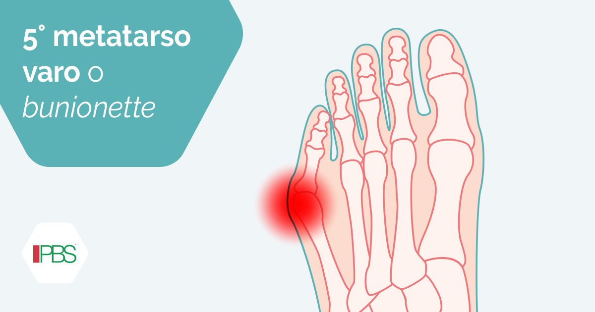 5° Metatarso varo: percorso di cura e intervento mini-invasivo PBS