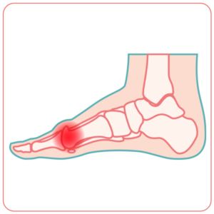 Piede e Alluce Valgo - PBS: innovazione nell'operazione chirurgica ...