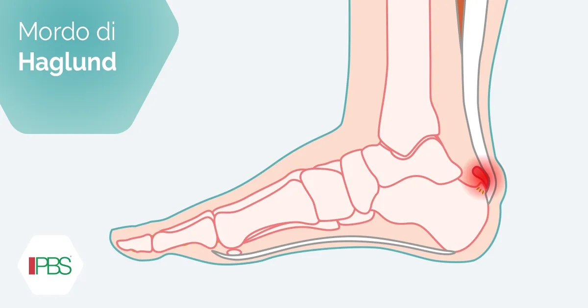 Morbo di Haglund - PBS: innovazione nell'operazione chirurgica ...